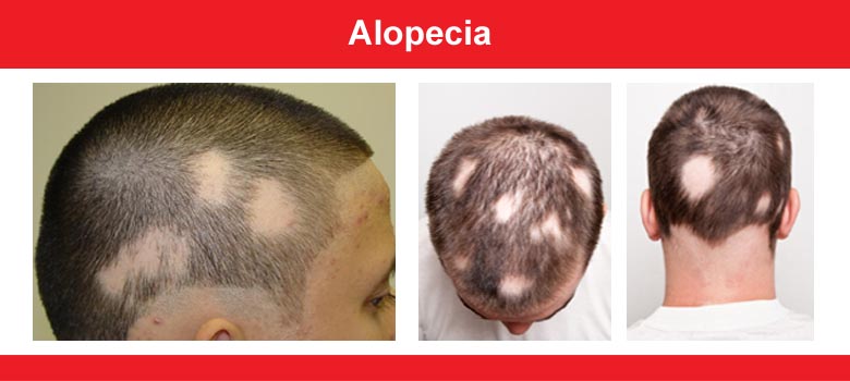 Best Alopecia Treatment in Ajmer, Jaipur, Rajasthan, India